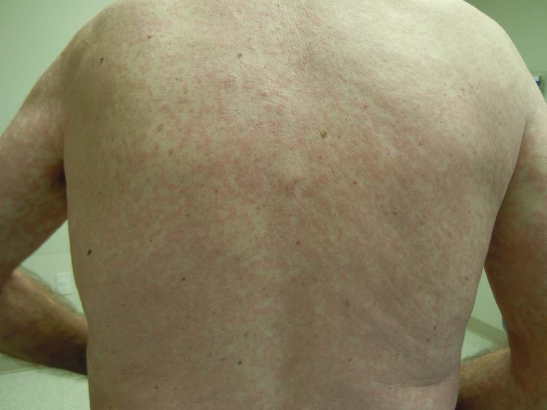 【morbilliform】什么意思_英语morbilliform的翻译_音标_读音_用法_例句_在线翻译_有道词典